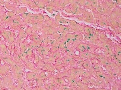 Hall's Method for Bilirubin - Delta Microscopies