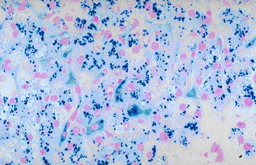 Prussian Blue Method for Hemosiderin - Delta Microscopies
